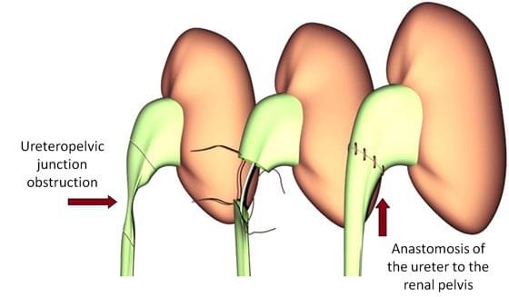 Ureteropelvic Junction Obstruction Upj Ureteropelvic Junction ...